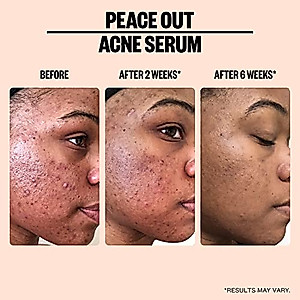 Peace Out Skincare Acne Serum. Daily Multi-Benefit Face Serum with 2% Salicylic Acid to Target Pimples, Zits, Blemishes and Breakouts, For Clearer-Looking Skin 1 fl oz