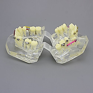 Smile1000 Dental Malocclusion Orthodontic Treatment Teeth Model with Metal Brackets Wires Colorful Ties Chains and Hoops M3005