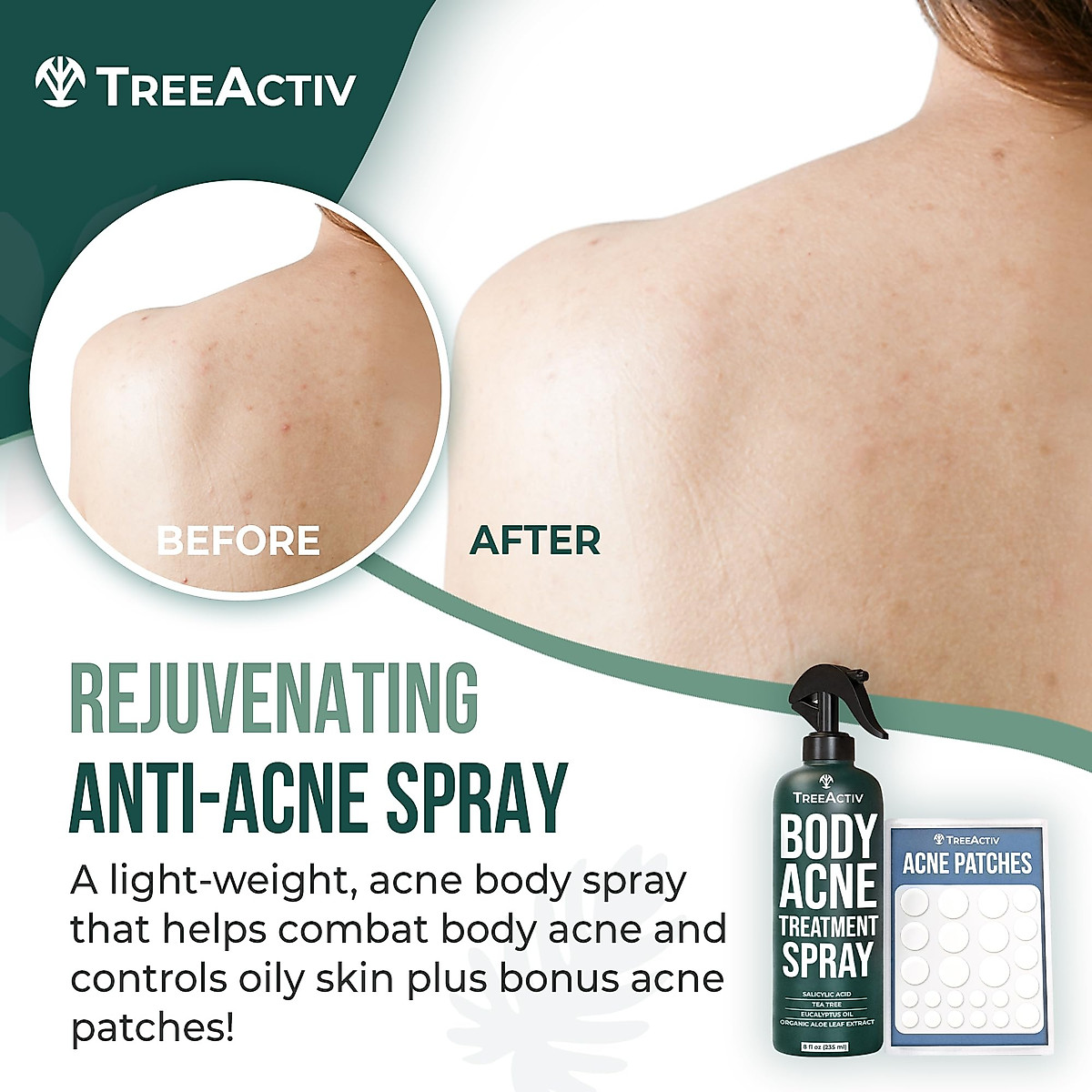 TreeActiv Body Acne Treatment Spray, 8 fl oz, 2% Salicylic Acid Spray for Body, Back Acne Treatment Spray with Tea Tree Oil and Aloe Vera, Gentle Back Acne Spray that Clears Body Acne, 2000+ Uses