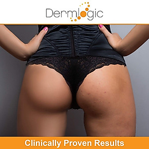 Anti-Acne Thigh & Buttocks Treatment - Clears Away Acne, Pimples, and Ingrown Hairs for the Buttocks and Thigh Area. Prevents Future Breakouts. 6.09 oz