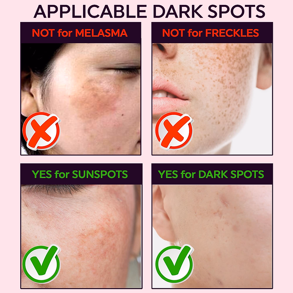 Micropoints for Acne Dark Spot Treatment - Post-Blemish Dark Spots Removal Patch with 127 Mircropoints, Fade & Brighten Post Acne Marks or Dark Spots (9 count/pack)