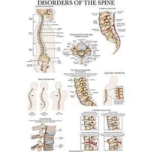 Palace Learning Disorders of the Spine Anatomy Poster - Laminated Spinal Disorders Anatomical Chart - 18" x 24"