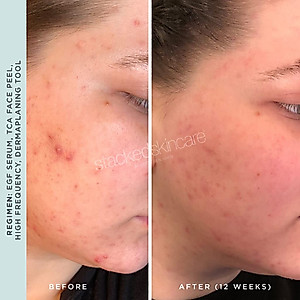 StackedSkincare High Frequency Wand for Acne, Face Tool to Clear Pores and Reduce Redness, Includes Gas Electrodes