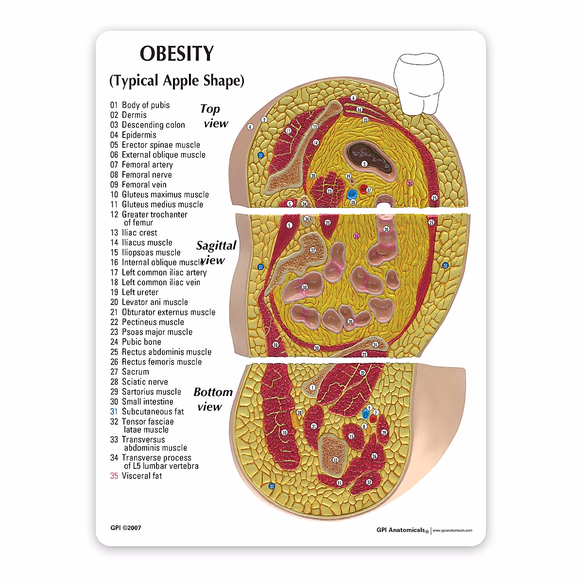Obesity Model | Human Body Anatomy Replica of Overweight Body Types for Doctors Office Educational Tool | GPI Anatomicals