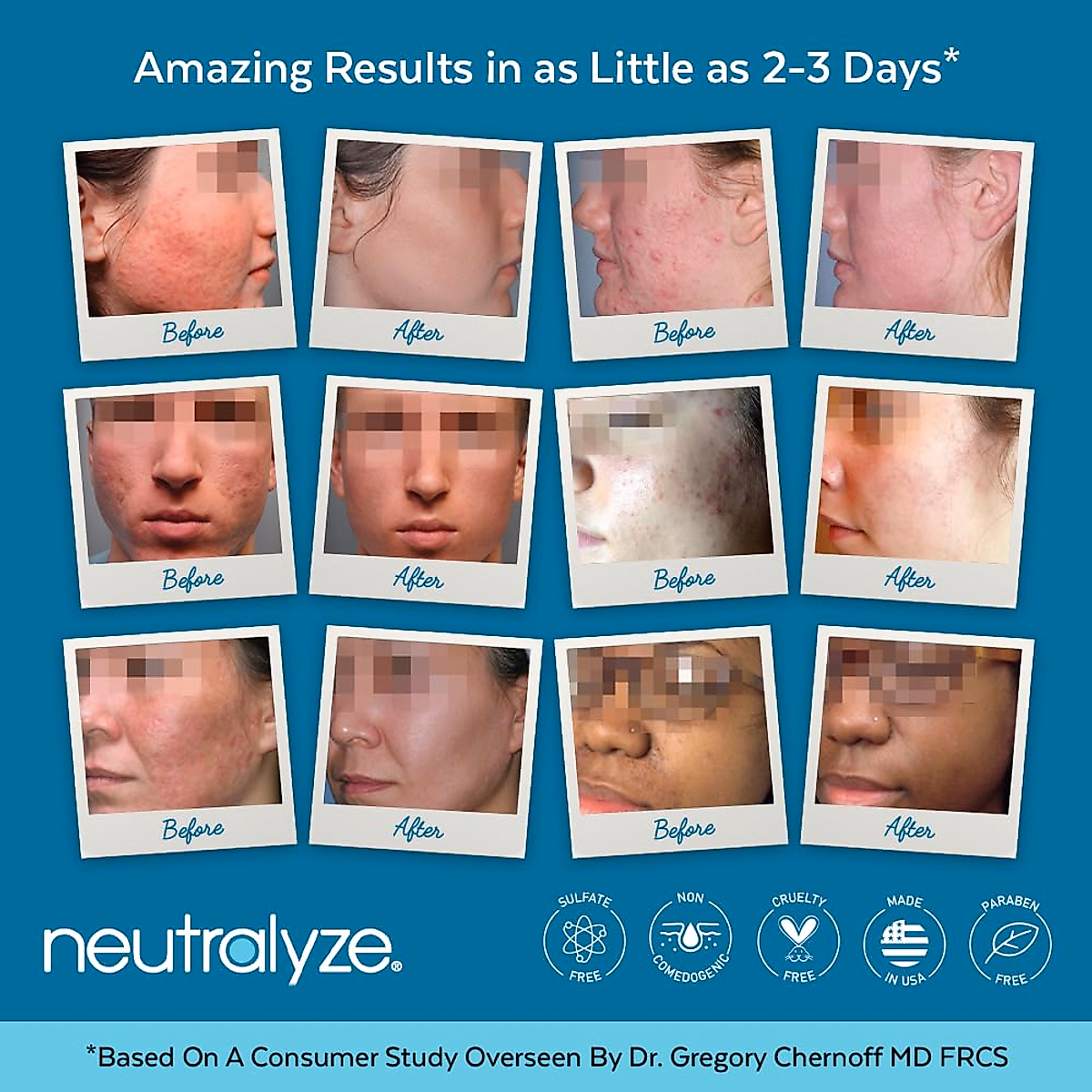 Neutralyze Maximum Strength Acne Moisturizer for Face & Body - Time Released, Medical Grade 2% Mandelic Acid & Salicylic Acid Cream - Renewal Complex Facial Moisturizer for Acne Prone Skin (90+ Day)