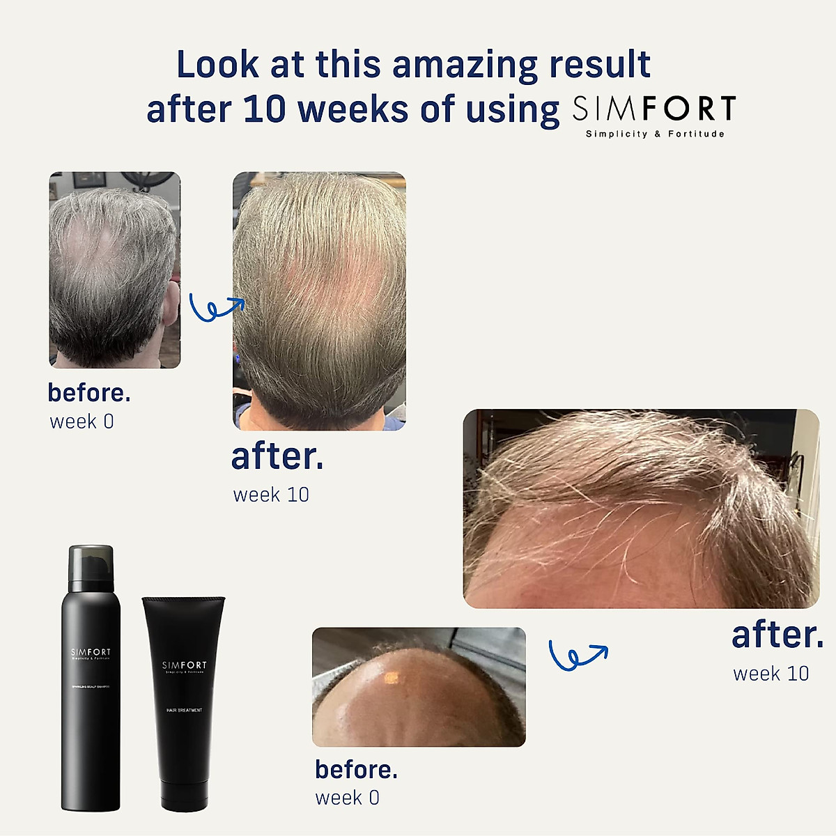 SIMFORT SPARKLING SCALP SHAMPOO for Thinning Hair and Hair Loss - Hair Growth Treatment (3 Pack)