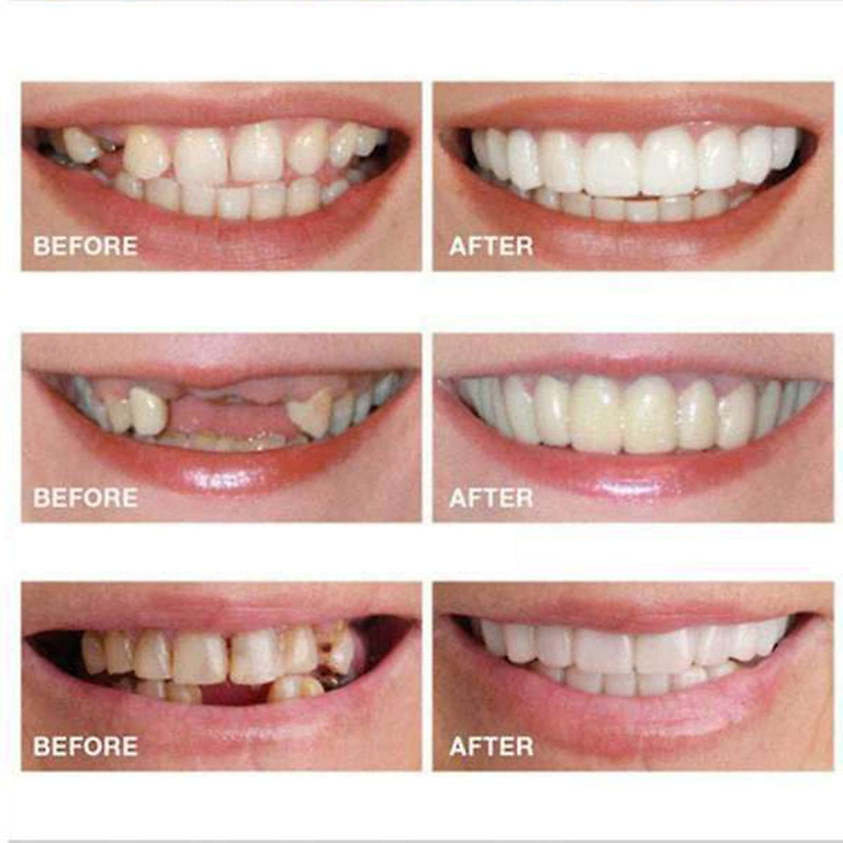 Dentures Fake Smile Teeth Moldable Customizable Temporary Top Teeth for Snap on Instant & Confidence Smile(3Boxes)