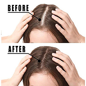 Hair Growth Serum, VOTALA Hair Growth Treatment, Anti Hair Loss, Promotes Thicker, Stronger Hair, And Hair Regrowth for Men Women