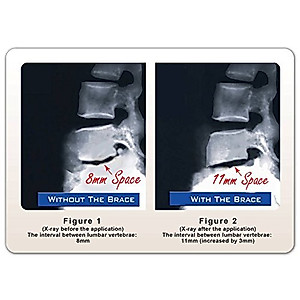 DDS 300 Decompression Belt - 6XL (Pneumatic Air Back brace, Back pain relief for Sciatica, Herniated disc, Pinched nerves, Stenosis, Degenerative Disc, Lumbar Traction)