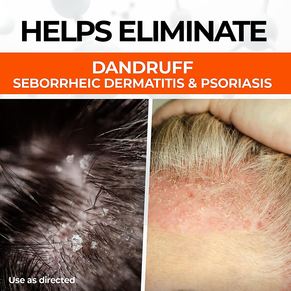 Medicasp Coal Tar Gel Anti Dandruff Shampoo, Treats Seborrheic Dermatitis & Psoriasis, Formulated for Dry, Flaky & Itchy Scalp Treatment, for Women & Men, 6 Ounce (Pack of 3)