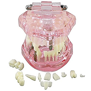 Dentalmall Teeth Model Teeth Typodonts Dental Implant Study Analysis Demonstration Teeth Model #2001 with Restoration Pink