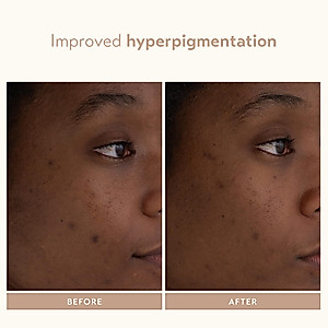 SHANI DARDEN SKINCARE Retinol Reform Anti-Aging Serum, Resurfacing Retinol Serum for Face and Neck, Helps with Fine Lines and Wrinkles, 1.01 fl oz