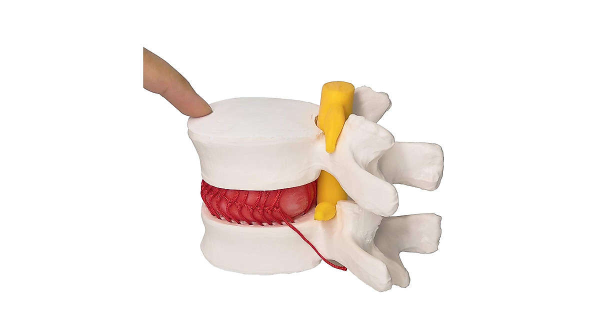 Human Herniated Disc Model for Medical Teaching and Learning