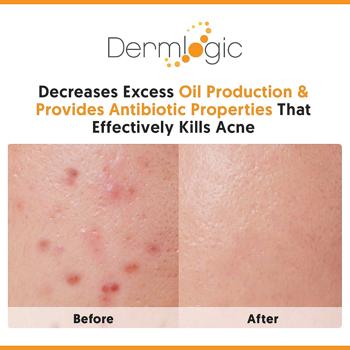 Dermlogic Acne Face & Body Cream- Maximum Strength Treatment for Cystic, Blackhead & Whitehead Pimples. Prevents Future Breakouts.
