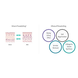 NeoGenesis PDO Combi Cog Threads for Face and Body Lift 20PCS (21G X 60MM)