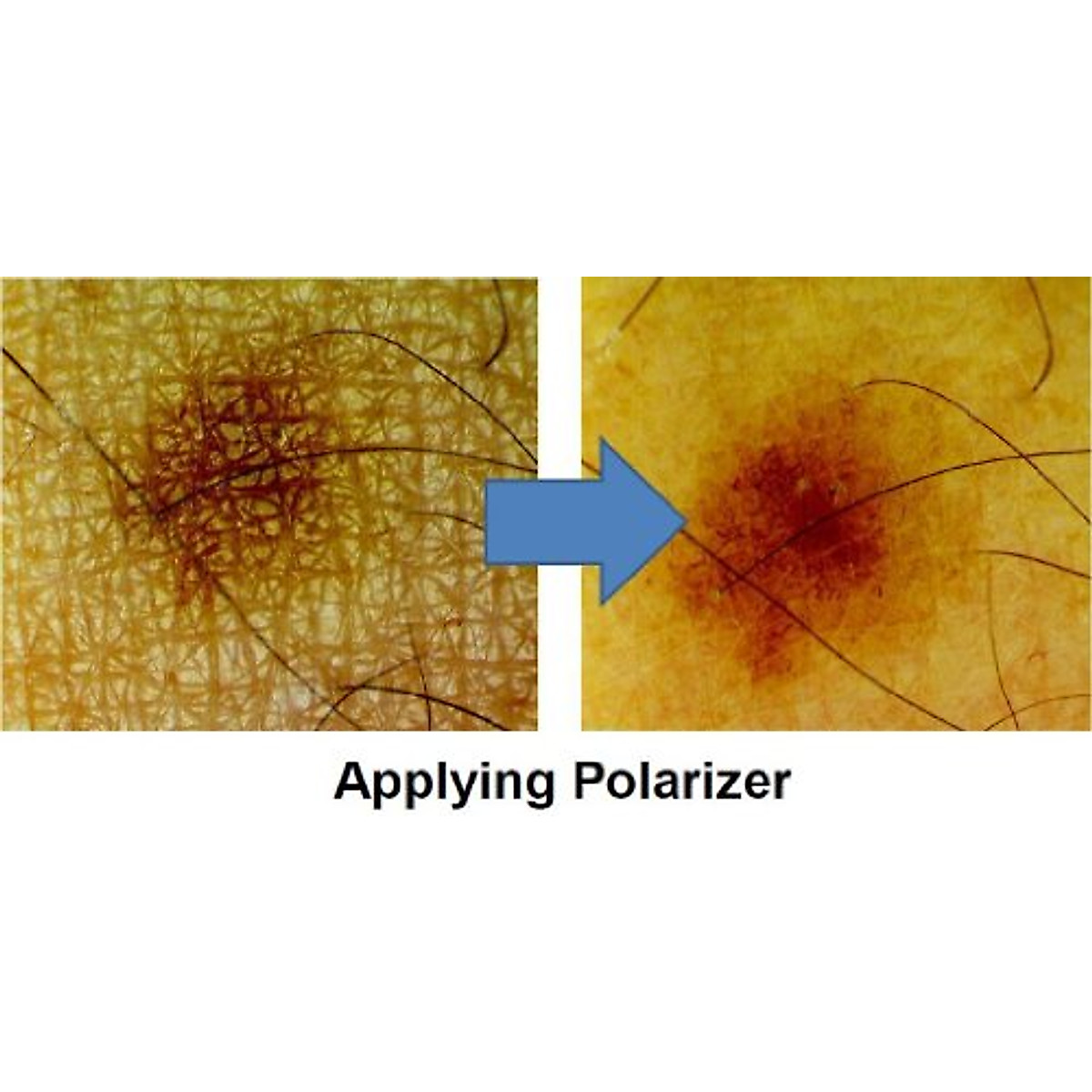 Firefly DE350 Wireless Polarizing Dermatoscope