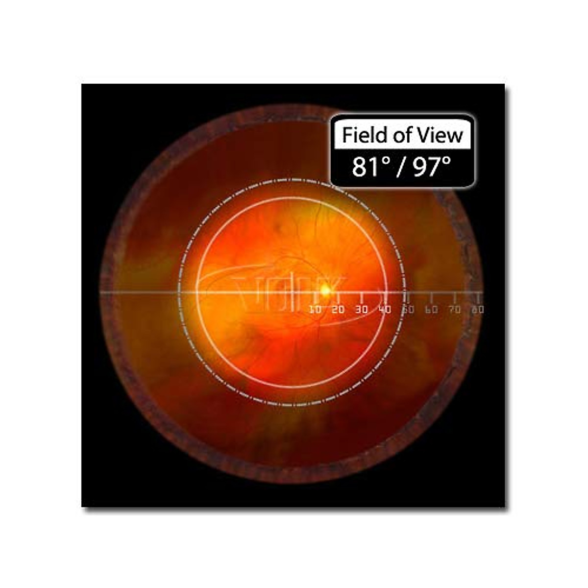 Volk Optical 78D Indirect Ophthalmic Slit Lamp Lens – Blue