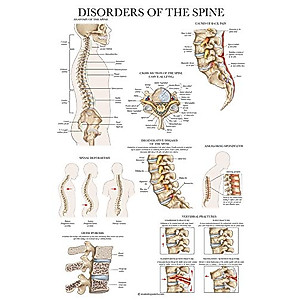 Palace Learning 2 Pack: Anatomy of the Spine + Disorders of the Spine Poster Set - Set of 2 Anatomical Charts - Laminated - 18" x 24"
