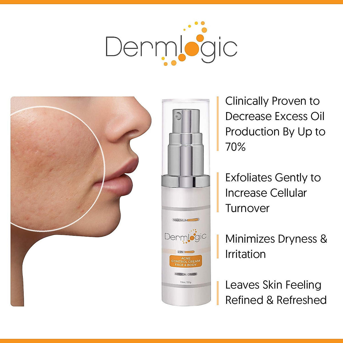 Dermlogic Acne Face & Body Cream- Maximum Strength Treatment for Cystic, Blackhead & Whitehead Pimples. Prevents Future Breakouts.