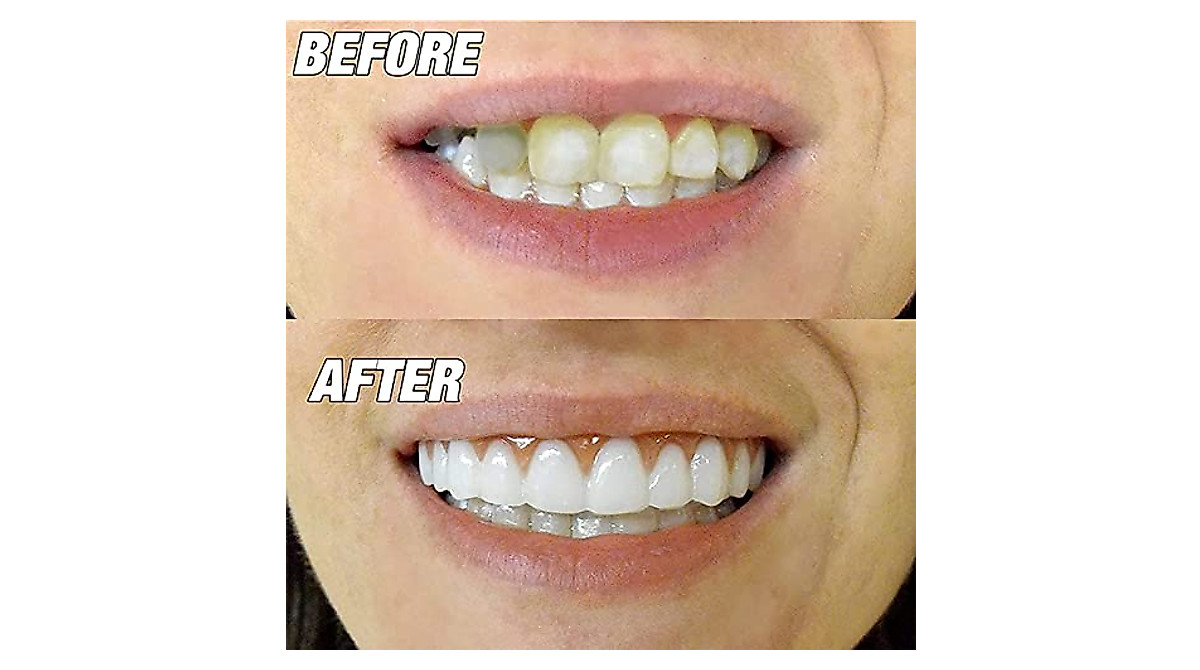 Adjustable Snap-On Dentures for a Natural Smile - Easy & Comfortable