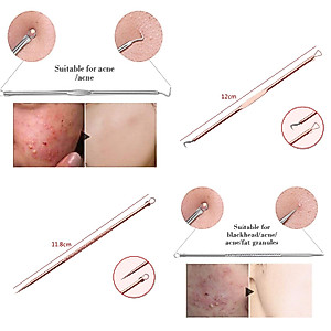 ZTRHYOO Blackhead Remover Pimple Comedone Extractor Tool Best Acne Removal Kit - Treatment for Blemish, Whitehead Popping, Zit Removing for Risk Free Nose Face Skin with Case(Rose, 4 Piece Set)