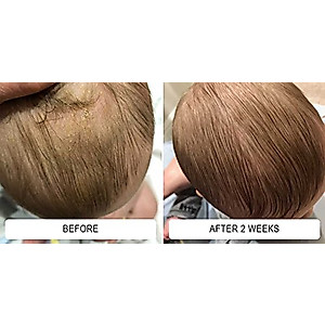 Happy Cappy Shampoo Bundle | Manage Cradle Cap, Seborrheic Dermatitis, Dandruff, and Dry, Itchy, Sensitive Eczema Prone Skin for All Ages…