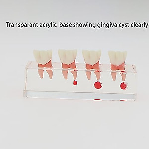 Dentalmall Dental 4-Stage Endodontic Treatment Model for Study Teach Teeth Model 4018 Root Canal Anatomy Demonstration Teaching Tooth Model