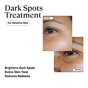 MATKAS Korean Dark Spot Remover for Face & Body Serum + Niacinamide + Oat Extract for Deep Correcting Uneven Skin Tone, Brightening Hyperpigmentation Treatment, Dark Spot Corrector Lightening Cream