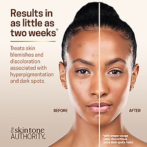 AMBI Even and Clear Foaming Cleanser | Salicylic Acid Acne Treatment | Clears and Helps Prevent New Acne Breakouts | Helps Visibly Improve Skin Tone and Texture | 6 Ounce