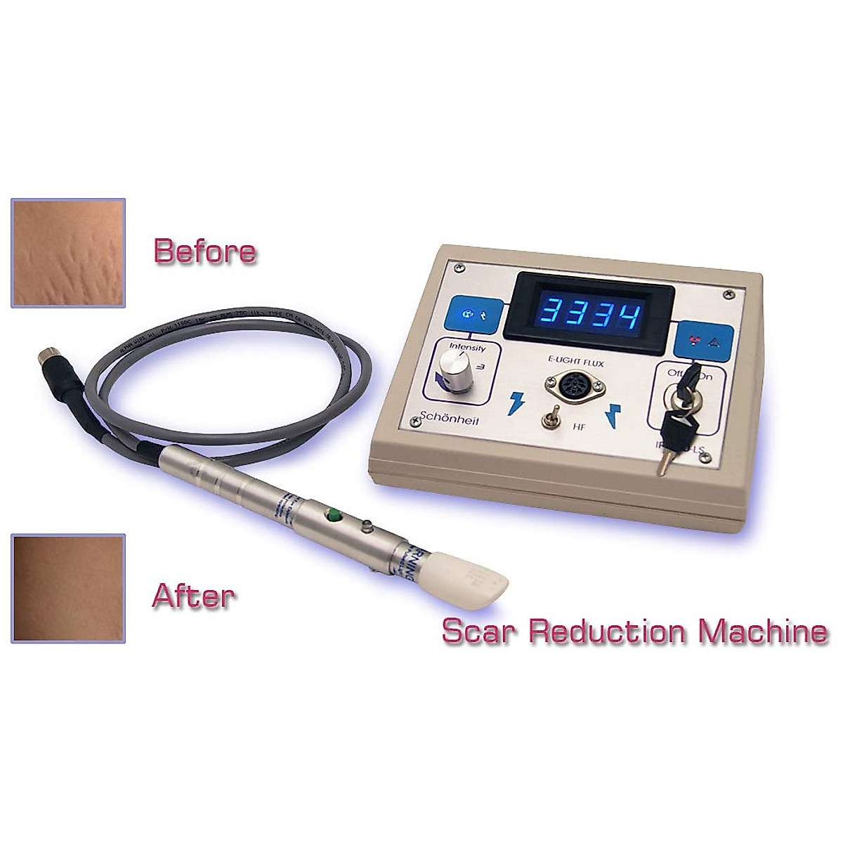 Home Salon Scar & Stretch Mark Removal Machine System.