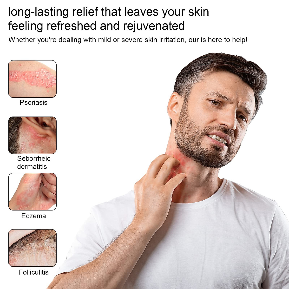 UEUEKOKO Eczema Psoriasis Manuka Relief Honey Cream, Hand Foot, Tinea Versicolor, Itchy Feet, Butt, Anal Itch, Scalp Dandruff, Bee Sting, Bites, Boil Cyst, Armpit, Adults Kids, Hidradenitis Treat