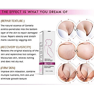 Stretch Mark Cream For Pregnancy Repair Scar Slack Line Abdomen Stretch Marks Cream, Remove Stretch Marks From Pregnancy, Repair Scar Slack Line Abdomen Stretch Marks Postpartum