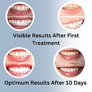 Teeth Whitening Gel for Trays 5 Pcs Fast Acting Teeth Whitening Gel Refill with Strongest 44% Carbamide Peroxide Gel, 2 Bleach Trays Included for Teeth Bleach, Enamel Safe, Gluten Free and Vegan