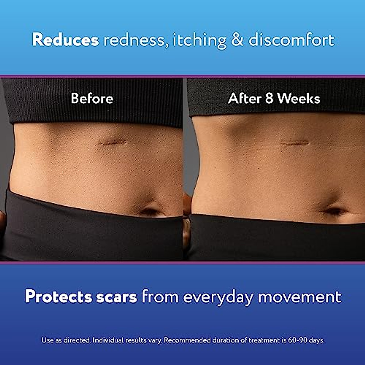 ScarAway Silicone Scar Gel, Helps Improve Size, Color & Texture of Hypertrophic & Keloid Scars from Injury, Burns & Surgery, Water Resistant, 10g (0.35 Oz)