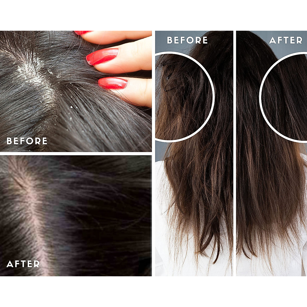 Herbal Dermatitis Dry Shampoo, Itchy Scalp Folliculitis Solution with Leave-In Tea Tree Oil Anti-Dandruff Conditioner for Men and Women. Safe and Effective for Sensitive Skin and Scalp.