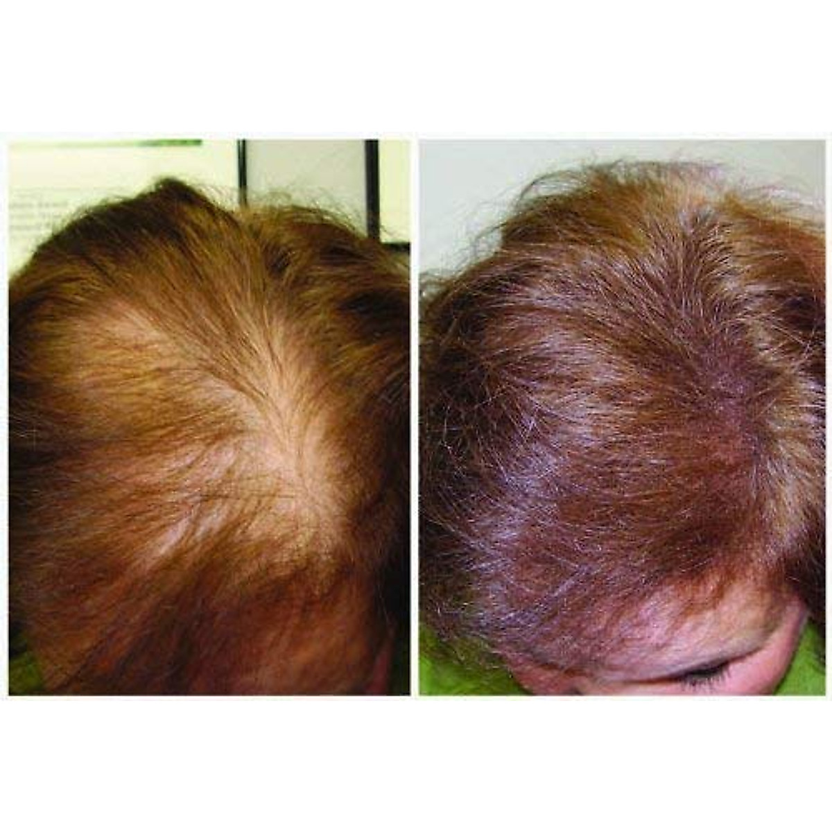 Miracle Plus Thick Hair Shampoo for Thinning Hair for Men and Women 8oz.