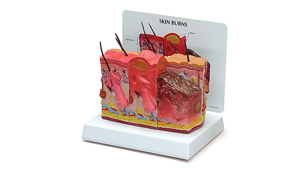 Skin Burn Anatomy Model - Enhance Patient Education