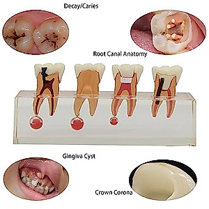 Dentalmall Dental 4-Stage Endodontic Treatment Model for Study Teach Teeth Model 4018 Root Canal Anatomy Demonstration Teaching Tooth Model