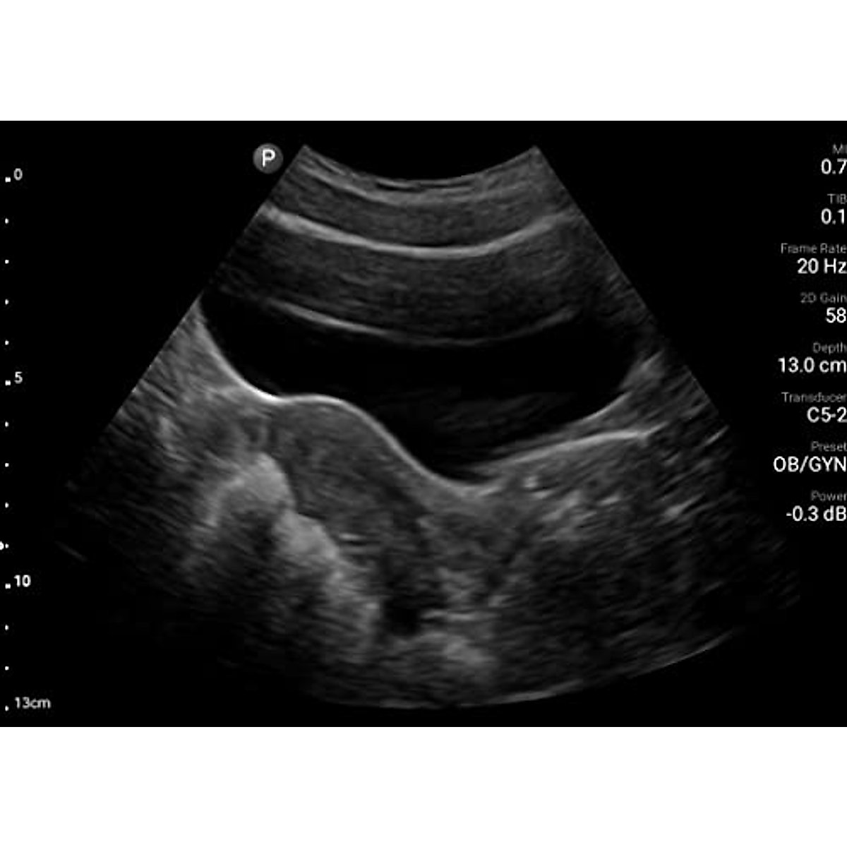 Philips Lumify C5-2 Curved Array Transducer, Portable Ultrasound Solution