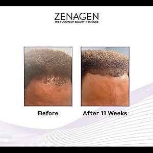 Zenagen Revolve Thickening Hair Loss Treatment for Men, 6.75 Fl Oz