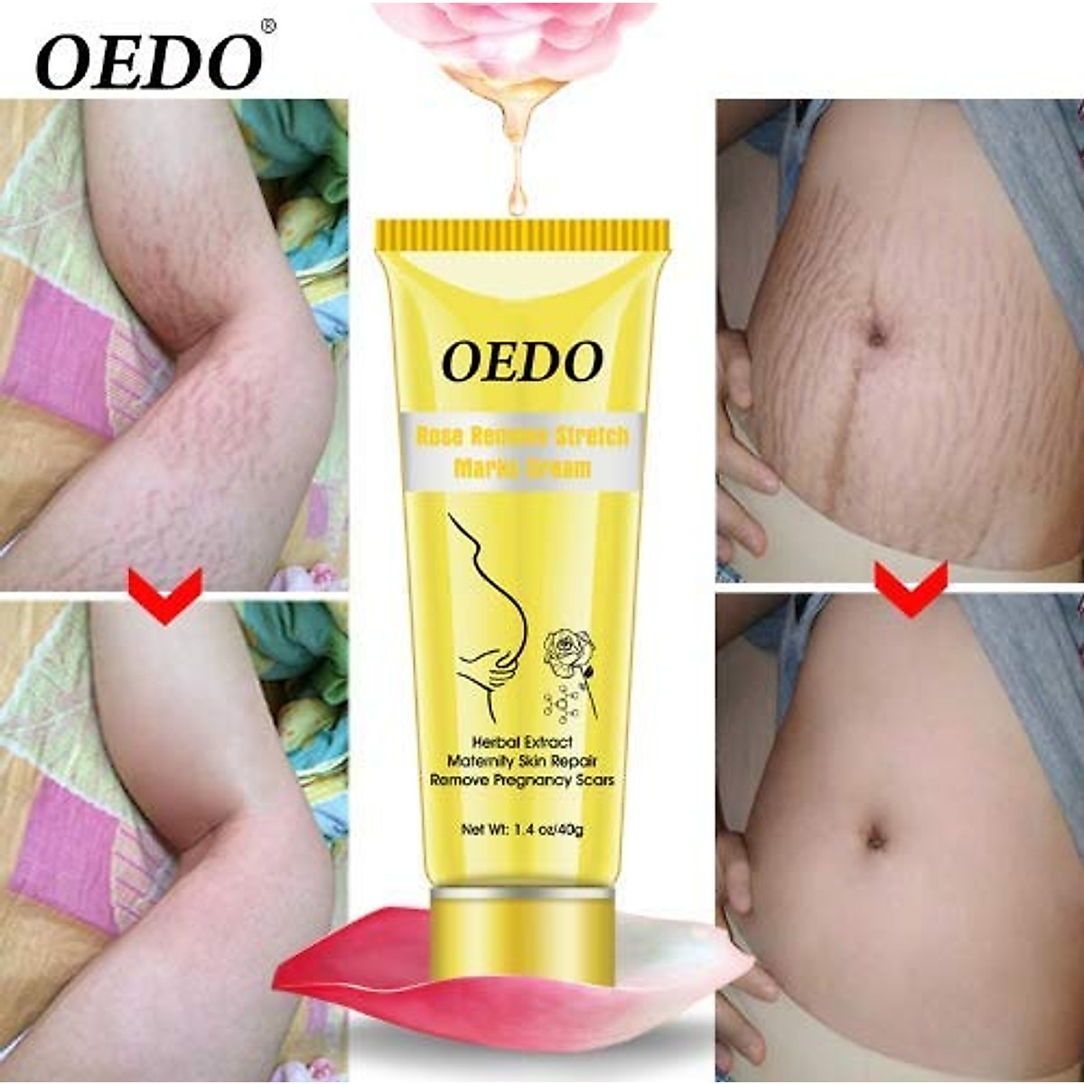 1pcs Remove Stretch Marks Cream Anti Wrinkle Anti Aging Maternity Skin Repair Remove Pregnancy Scars Treatment Body Skin Care