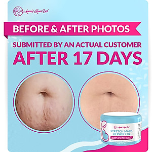 Stretch Mark Oil Cream for Pregnancy & Scar Removal Cream by Mommy Knows Best - Stretch Mark Remover Cream & Scar Cream - Shea & Cocoa Butter Stretch Mark Cream Remover for Maternity Skin Care