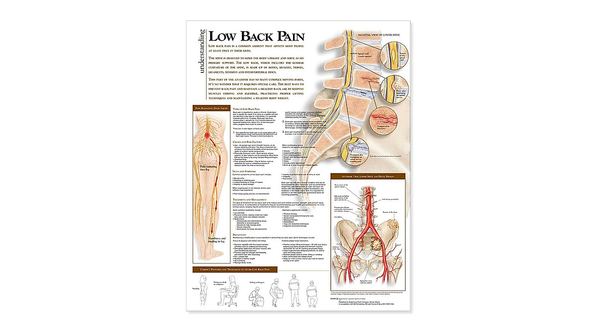 Understanding Low Back Pain Anatomical Chart - Visual Guide for Healthcare