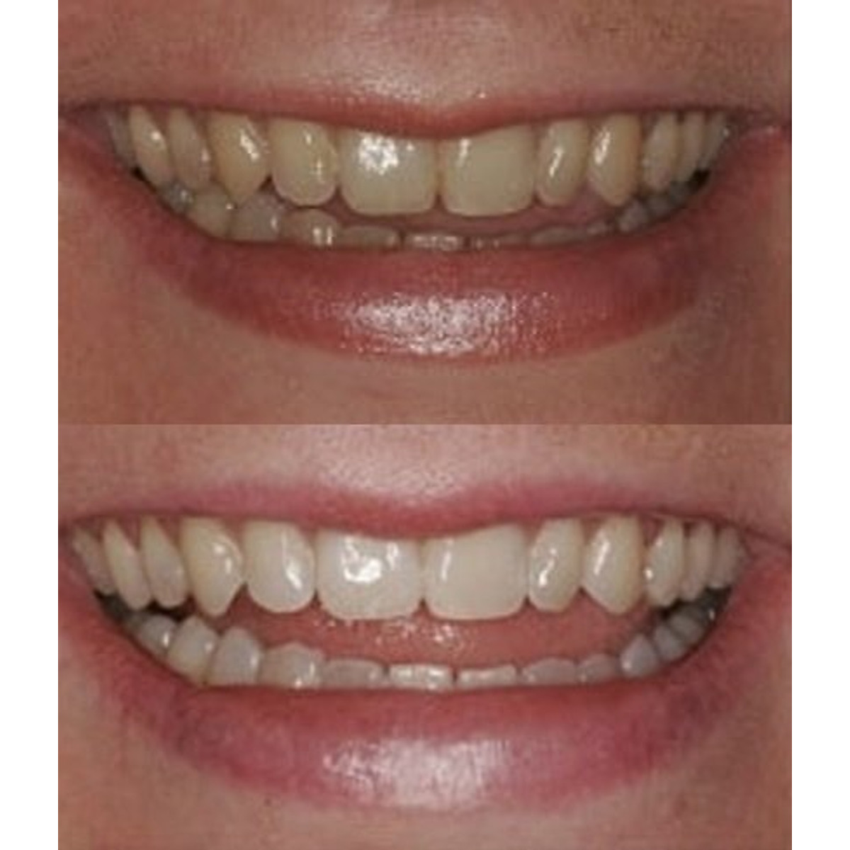 ProDental Teeth Whitening Gel Syringe Refill 10 Pack, 35% Carbamide Peroxide - 60 Treatments, Faster Results Than Tooth Whitening Strips - Pen - Powders and Toothpaste, Safe for Sensitive Teeth