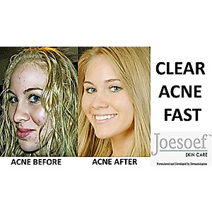 JOESOEF SKIN CARE Sulfur Soap for Acne Pharmaceutical Grade Dermatologists Approved for Acne Rosacea 100G