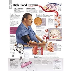 High Blood Pressure chart: Wall Chart