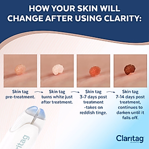Claritag Advanced Skin Tag Remover - FDA-Cleared Device - Only for Skin Tag Removal - Works in 7-14 Days - Up to 10 Treatment Cycles - Cryogenic Freeze-Off Kit