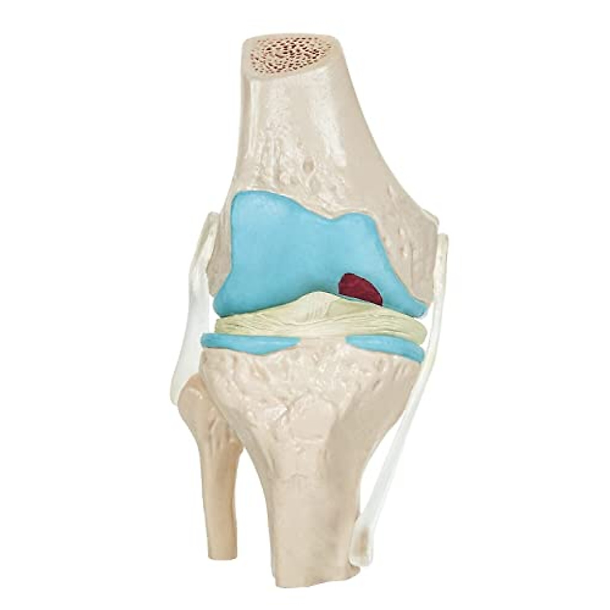 Spancare 4 Stage Osteoarthritis Anatomical Knee Model, Model On Base, with Detailed Study