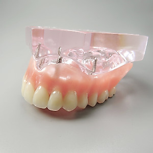 Dental Model Overdenture Upper Teeth 4 Implants Demo for Teaching and Studying