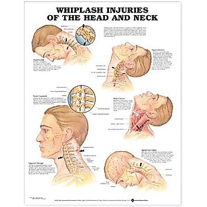 Whiplash Injuries of The Head and Neck Anatomical Chart